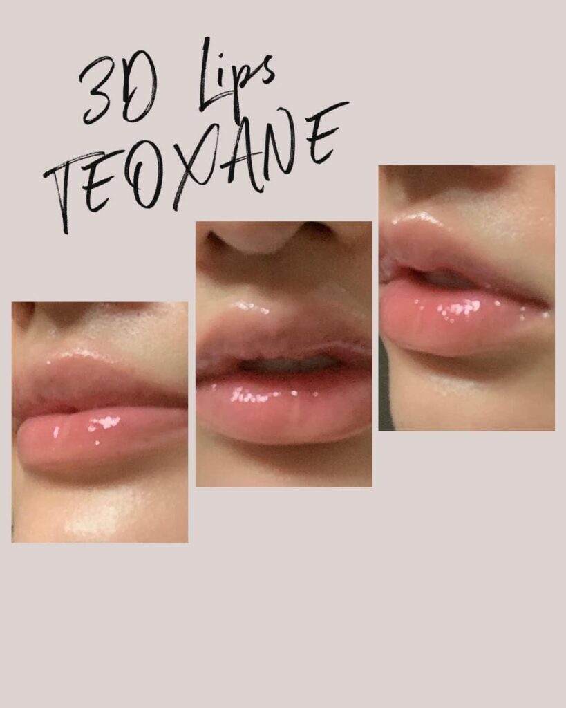Gel dưỡng làm đầy căng mọng môi Teoxane 3D Lip (10ml) - Hải Yến Cosmetic